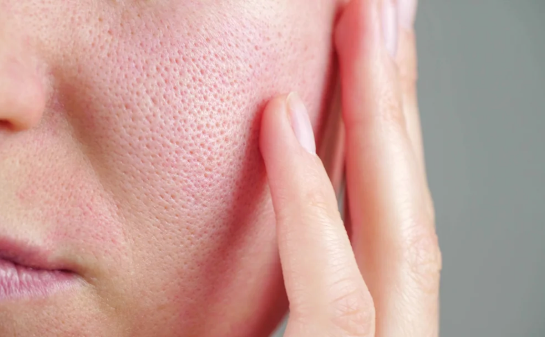 What You Need to Know to Prevent Pores Formation – Lakani Beauty